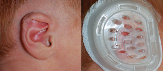 Key Steps In Newborn Ear Correction Process | myPediaclinic