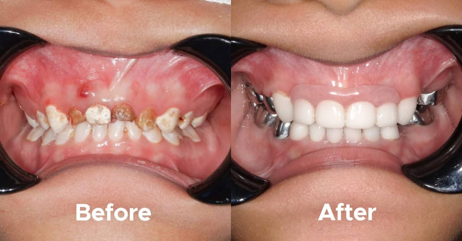 White Crown Vs Stainless Steel Crown - What's Right For My Child?