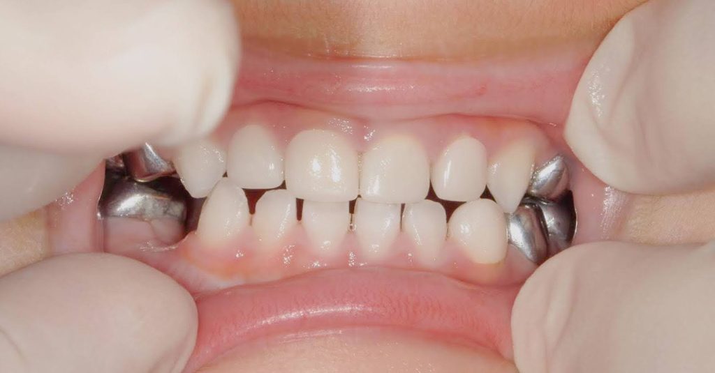 White Crown Vs Stainless Steel Crown - What's Right For My Child?