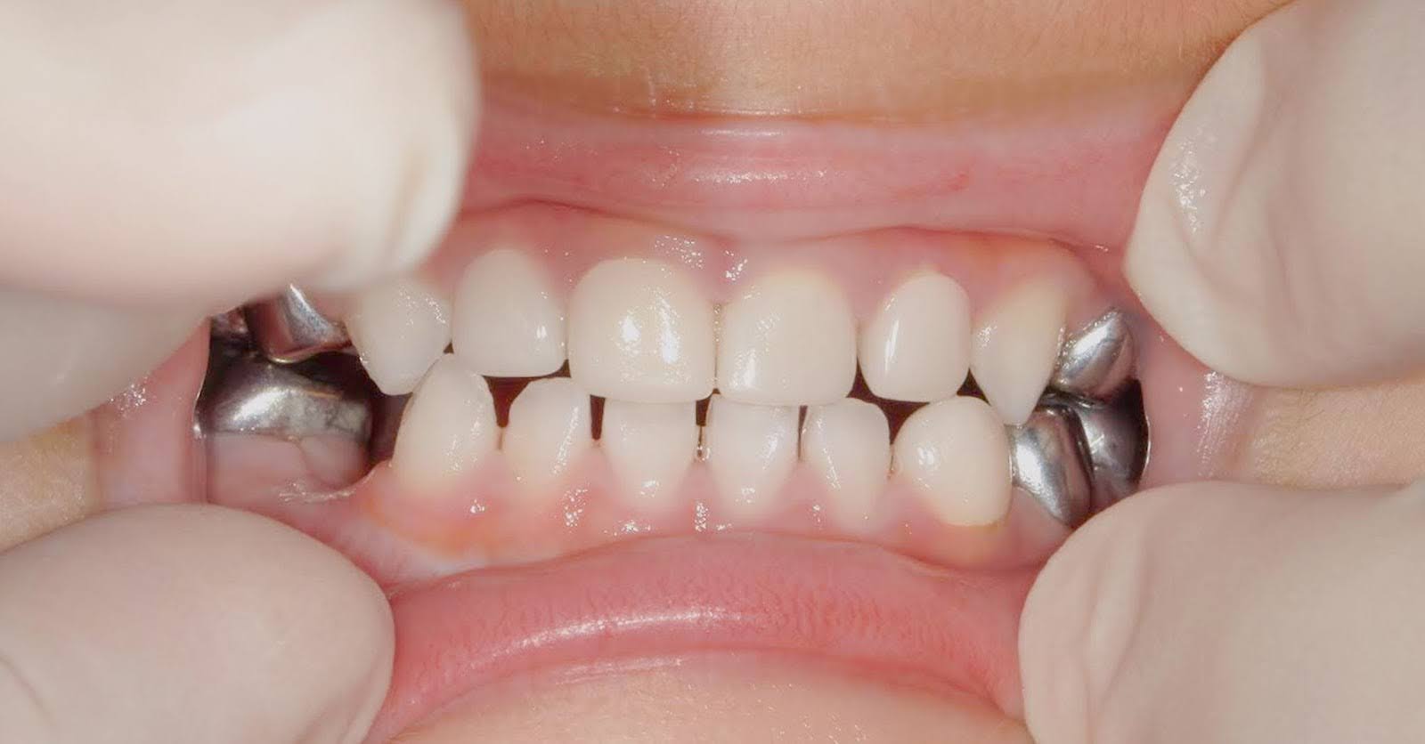 White Crown Vs Stainless Steel Crown - What's Right For My Child?